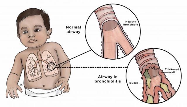 Bronchiolitis | KidsHealth New Zealand's Trusted Voice On Children's Health